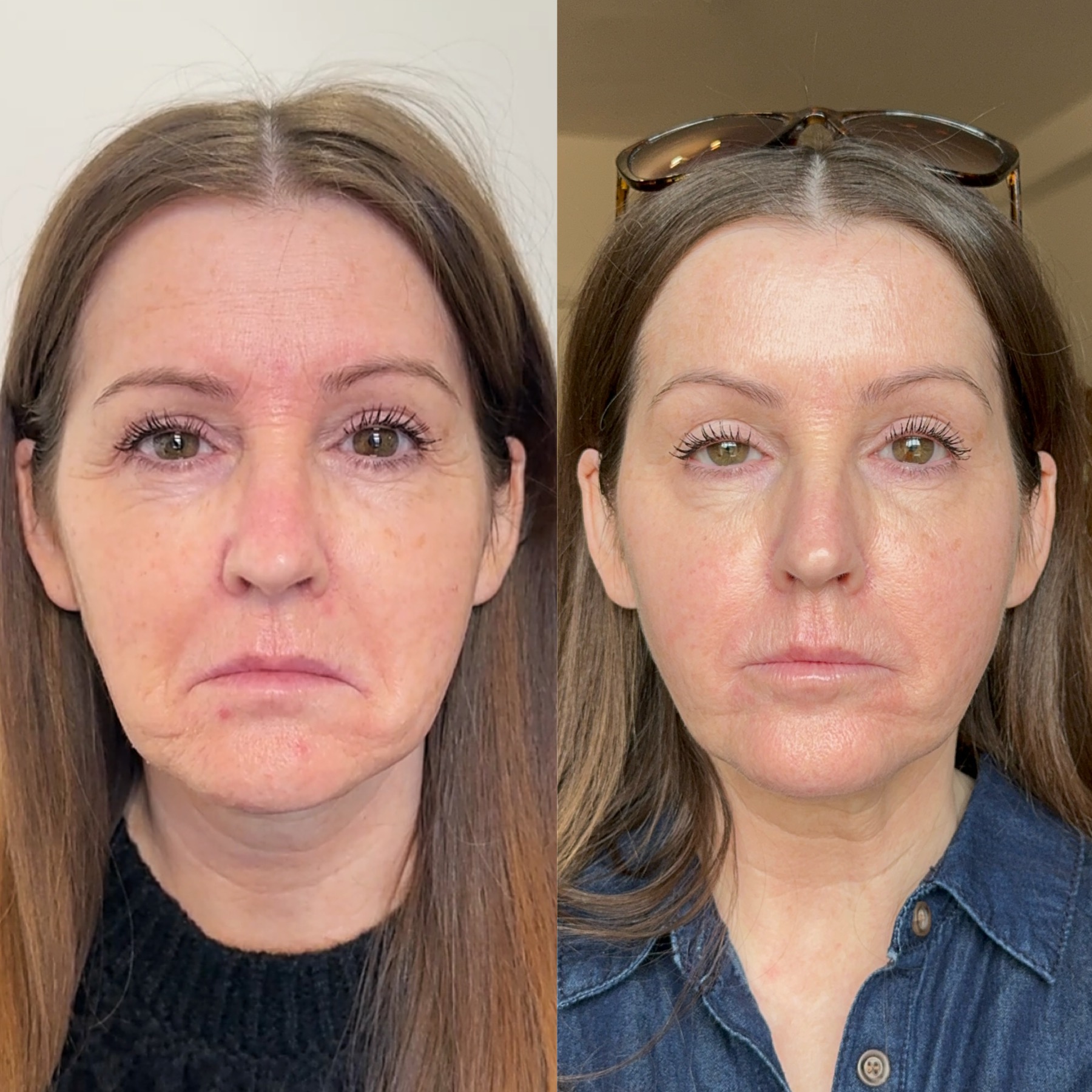 Muscle Balancing for Facial Ageing | Harmony Medical