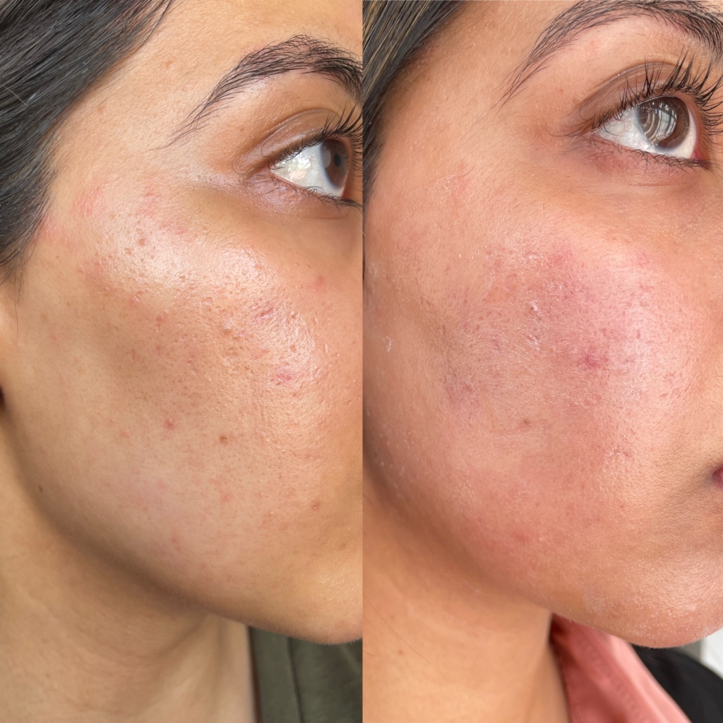 TCA Cross Peel - Harmony Medical Aesthetics | Cosmetic Dermatology ...