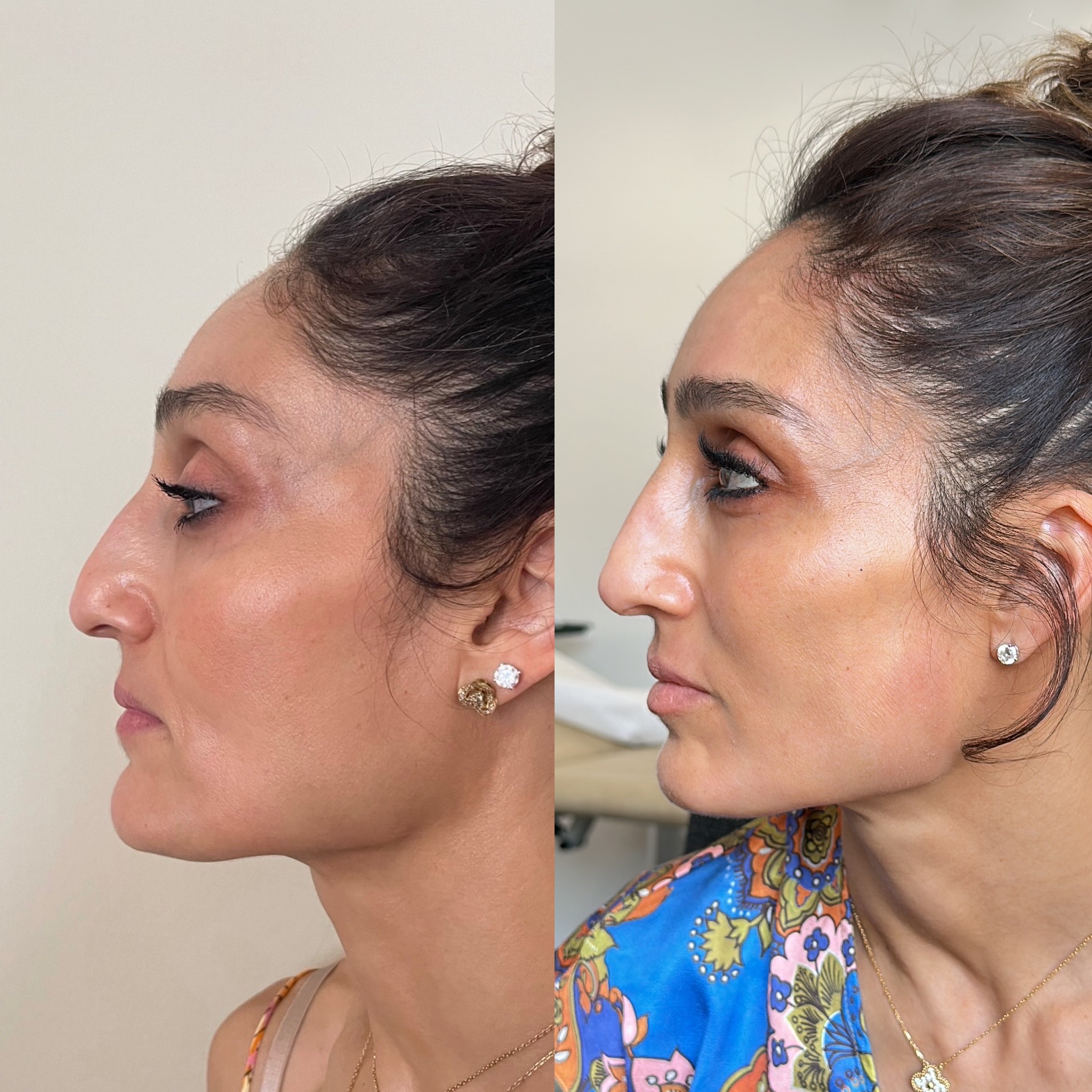 ASCE Exosomes Therapy - Harmony Medical Aesthetics | Cosmetic ...